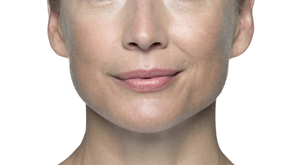 restylane-banner - Estrella Aesthetics & Surgical Arts